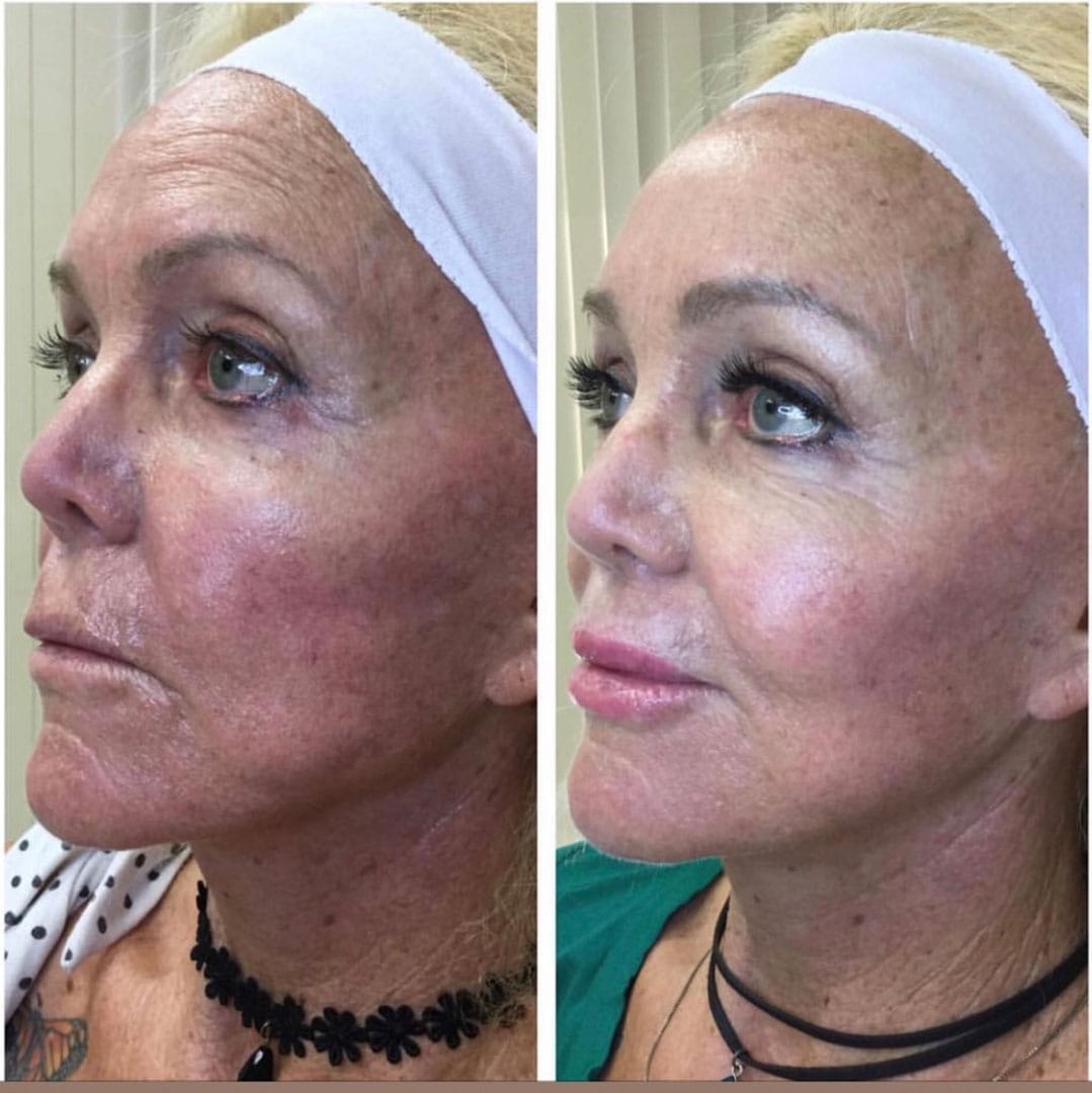 Sculptra Injection Restore Youth | Scottsdale