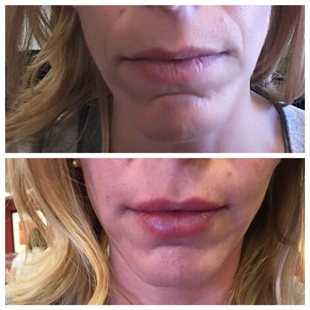 PRP/PRF Injections for Skin Rejuvenation | Scottsdale