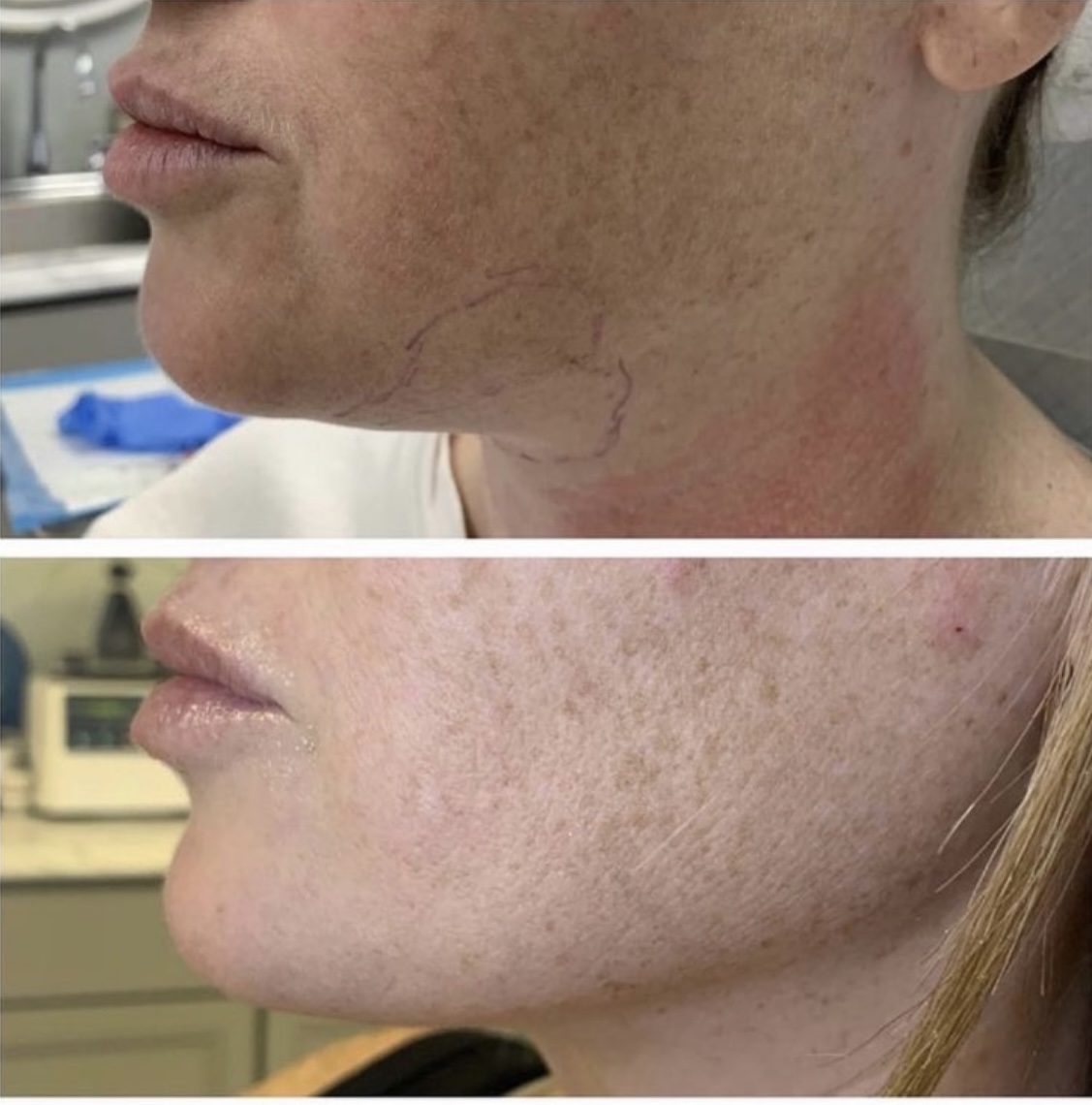 Agnes Precision RF Microneedling Treatment | Scottsdale