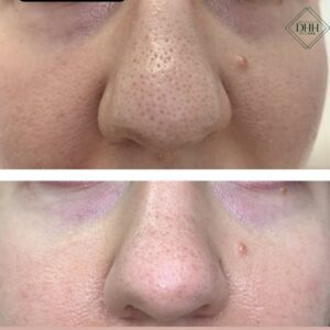Agnes Precision RF Microneedling Treatment | Scottsdale