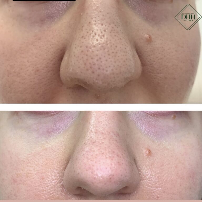 Dermaplaning Scottsdale | Facial | DHH Med Spa Scottsdale