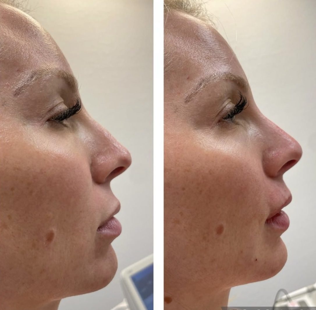 Agnes Precision RF Microneedling Treatment | Scottsdale