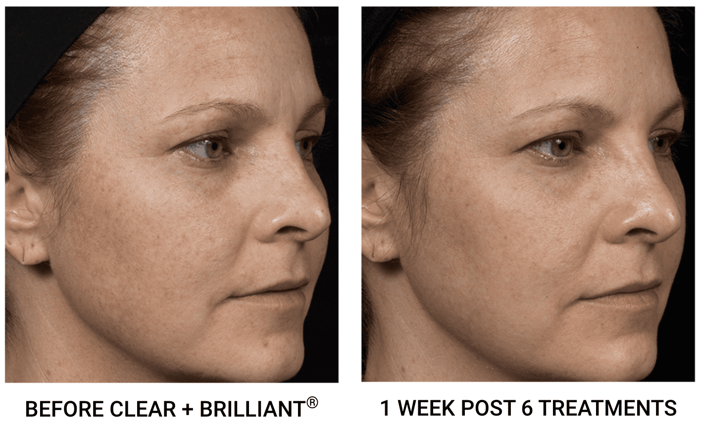 Clear and Brilliant Laser in Scottsdale | DHH Med Spa