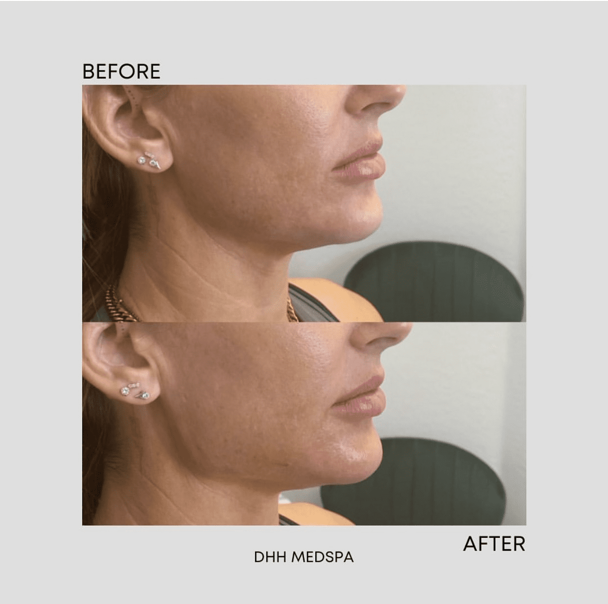 Radiesse Dermal Fillers - Rejuvenate & Restore at DHH Med Spa