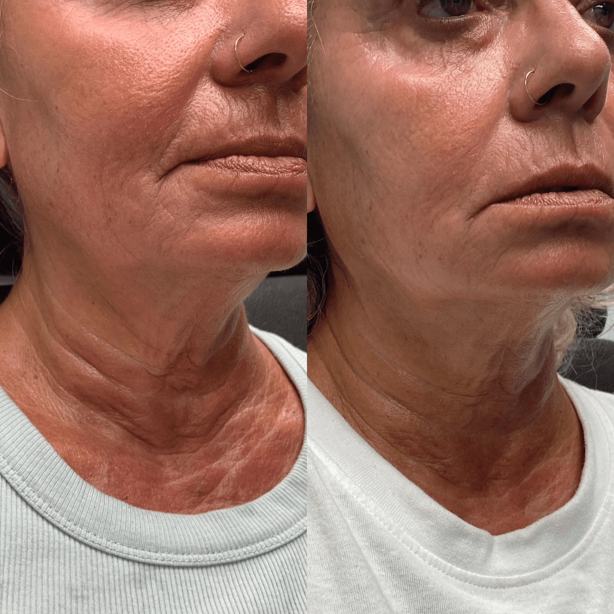 Radiesse Dermal Fillers - Rejuvenate & Restore at DHH Med Spa